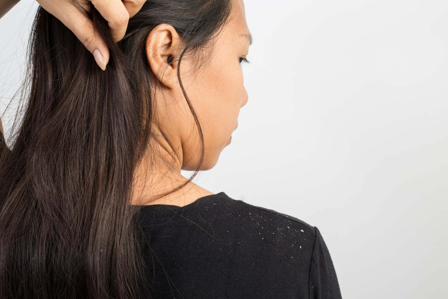 Causas de la seborrea, síntomas, remedios naturales y consejos