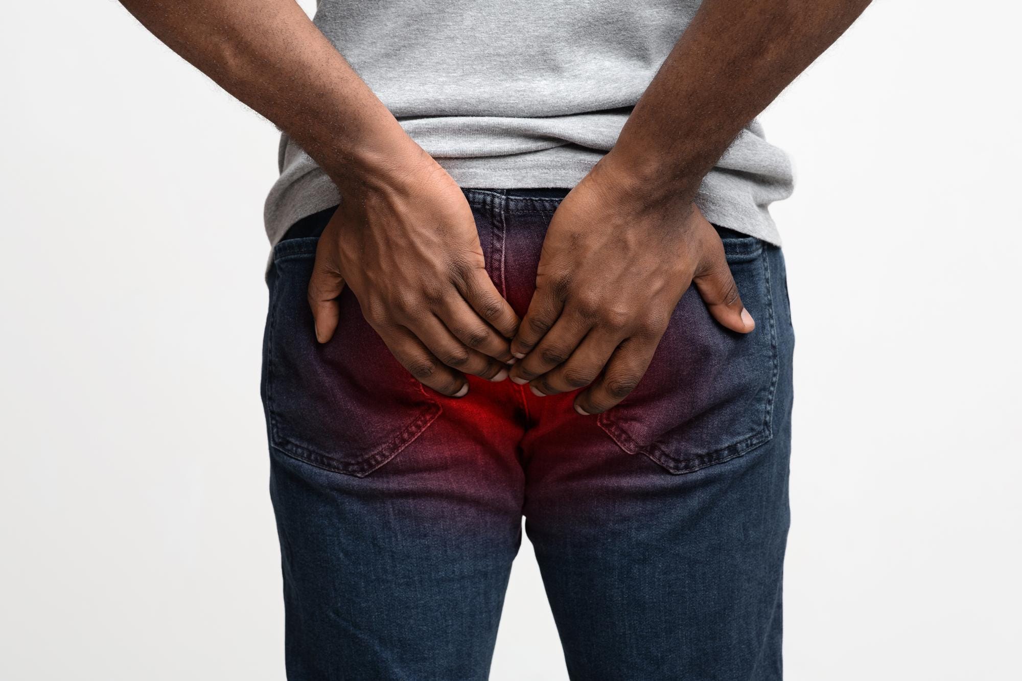 Prolapso rectal y hemorroides: ¿Es lo mismo?